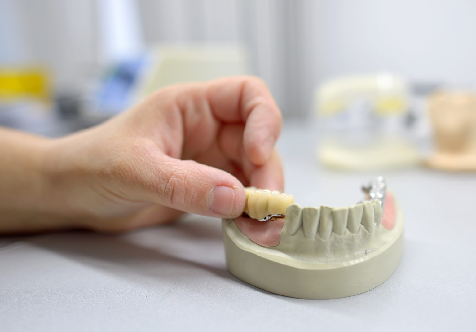 When is a Dental Bridge Recommended?
